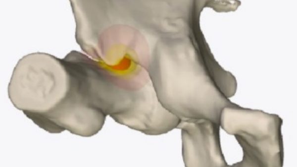 Types of Sport hip injuries with Mr Giles Stafford Consultant Surgeon