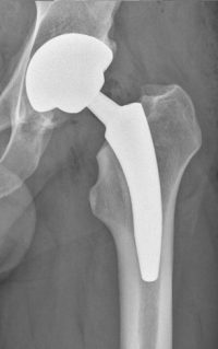 Total Hip Replacement London | Consultant Orthopaedic Hip Surgeon